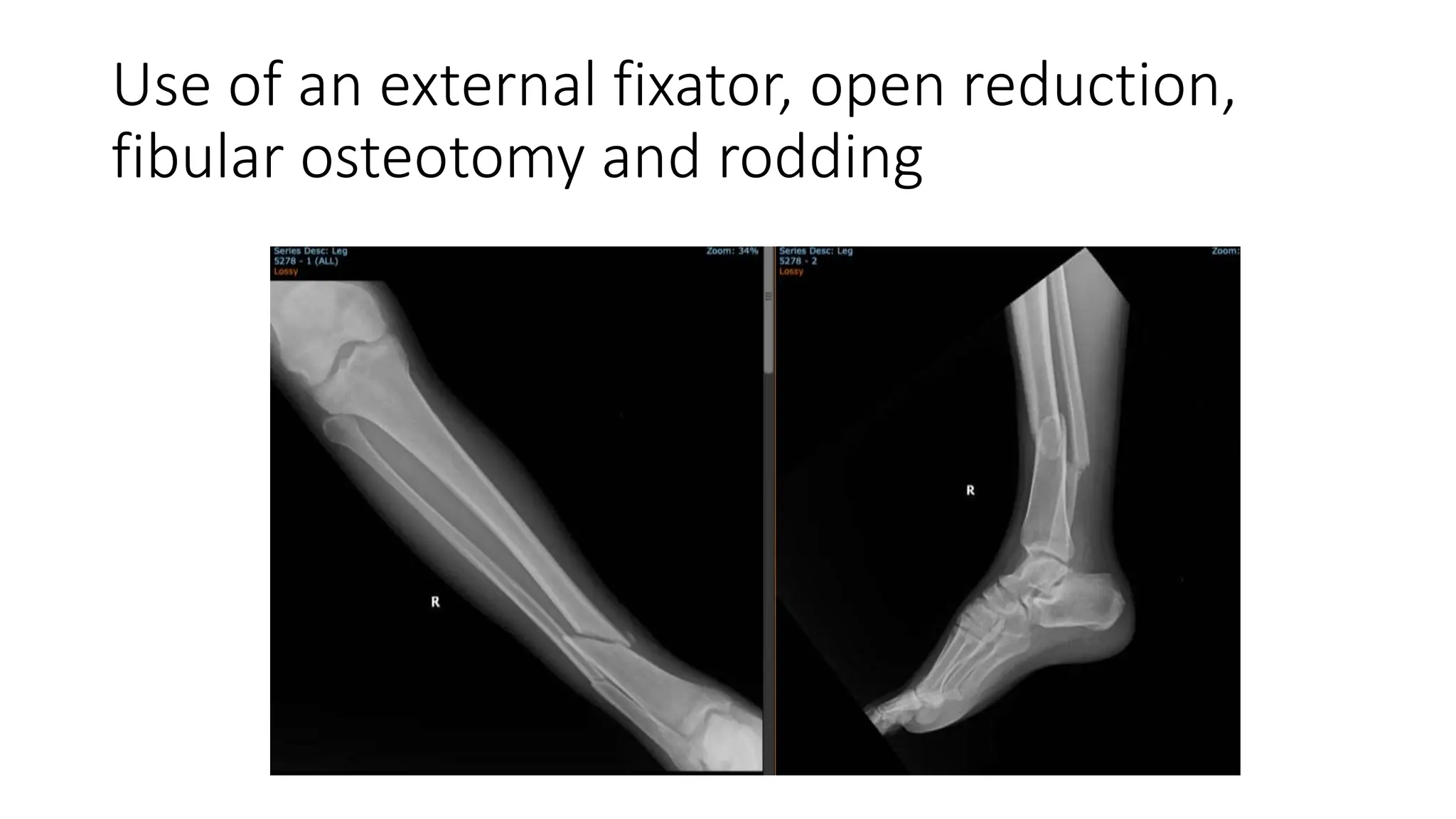 distal tibia malunion orthopedics sem.pptx