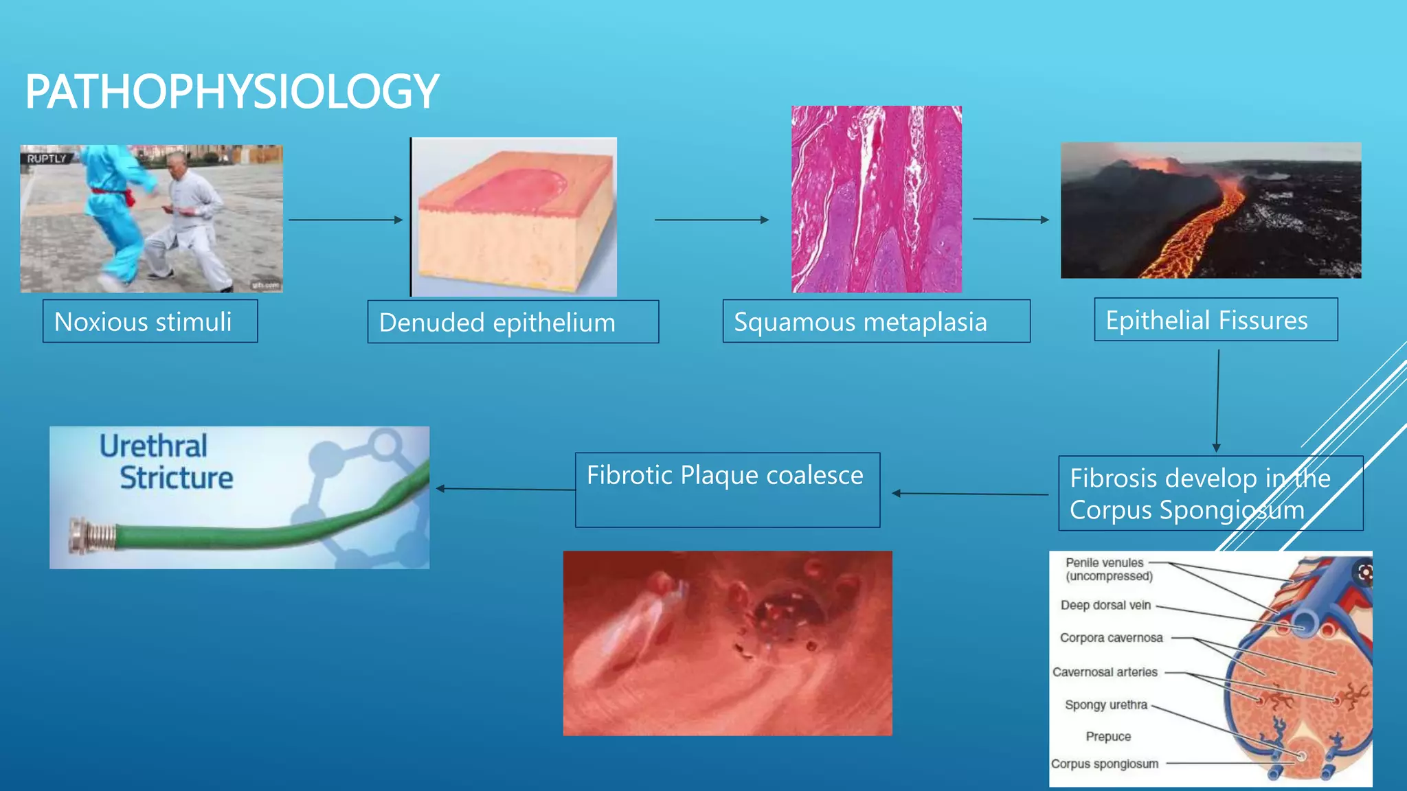 DISTAL URETHRAL STRICTURE.pptx