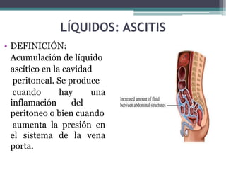 Distensión abdominal y Ascitis | PPTX
