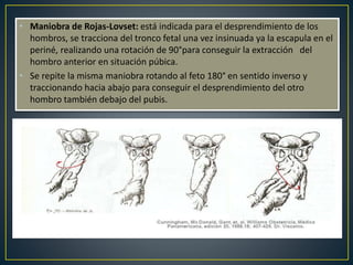 DISTOCIAS DE PARTO TRANSVERSA Y OBLICUA DEL FETO Y PRESENTACIÓN ...