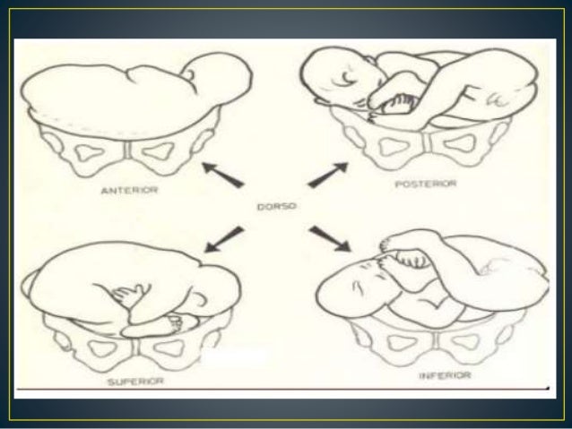 DISTOCIAS DE PARTO TRANSVERSA Y OBLICUA DEL FETO Y PRESENTACIÓN PODÁL…