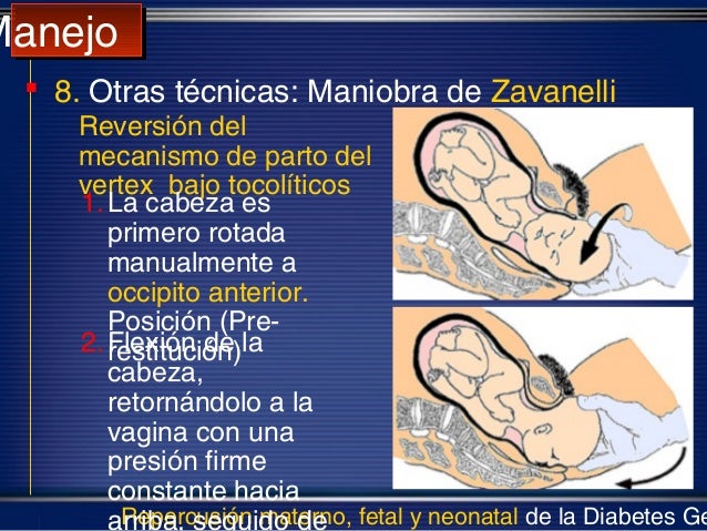 Distocia de hombros clase huespe