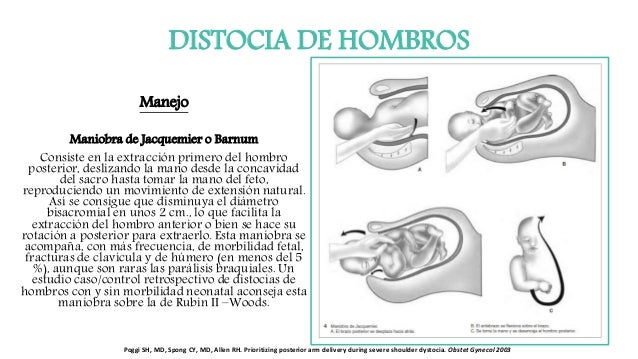 Distocia de hombros