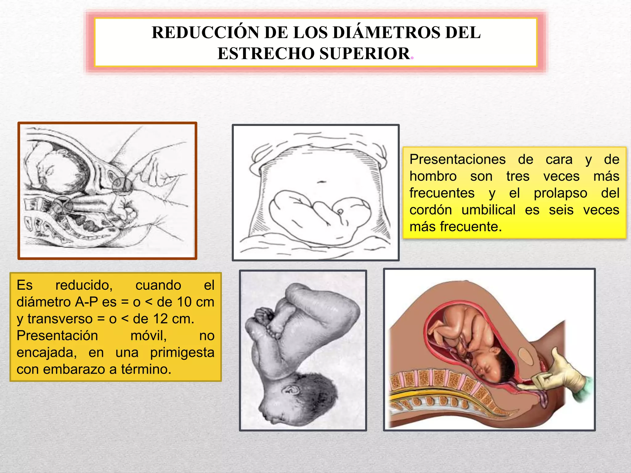 Distocia de pelvis | PPTX