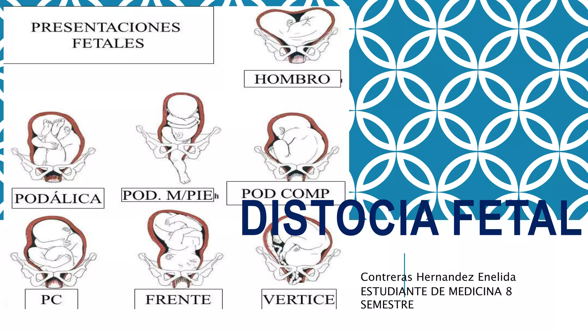 Distocia fetal | PPT