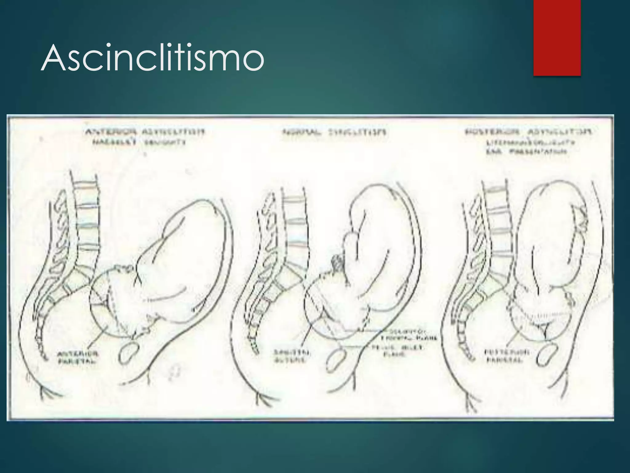 Distocia fetal | PPTX | Pregnancy | Reproductive Health