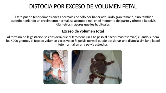 DISTOCIA POR EXCESO DE VOLUMEN FETAL.pptx