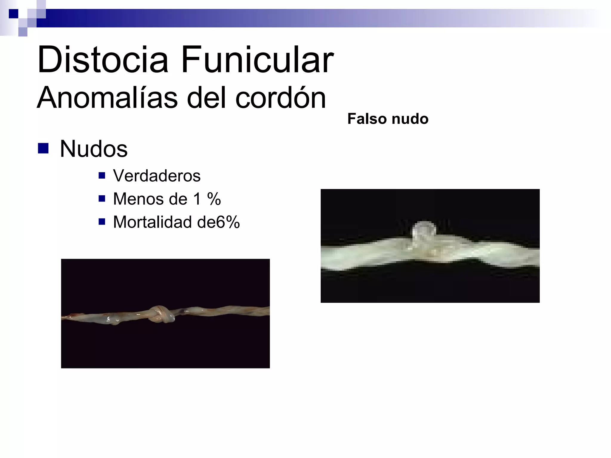 Distocias Funiculares | PPT