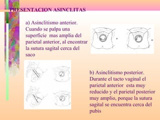 Distocias de contracción. | PPT