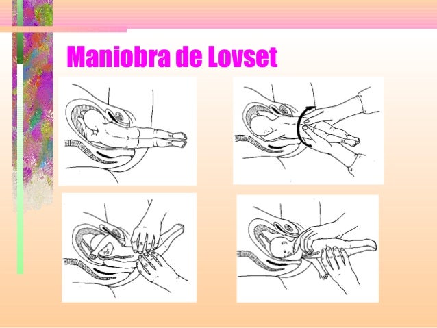 Distocias de contracción.