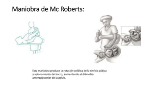 distocias de hombros .pptx