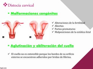 Distocias del parto | PPTX