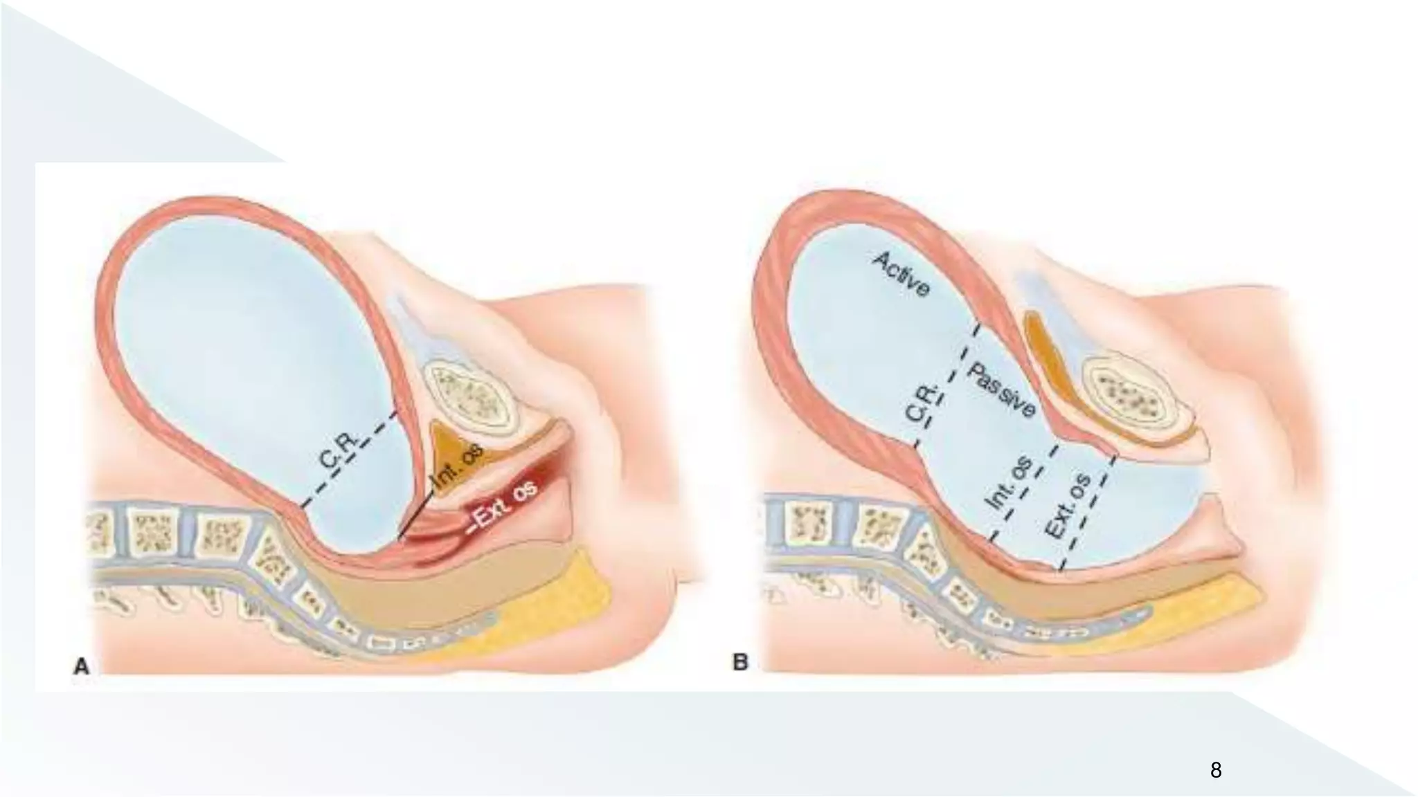 DISTOSIA-EC-KELAINAN-KONTRAKSI.ppt