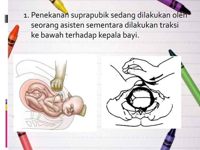 Distosia bahu | PPTX