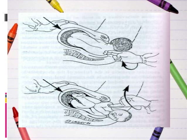 Distosia bahu | PPTX