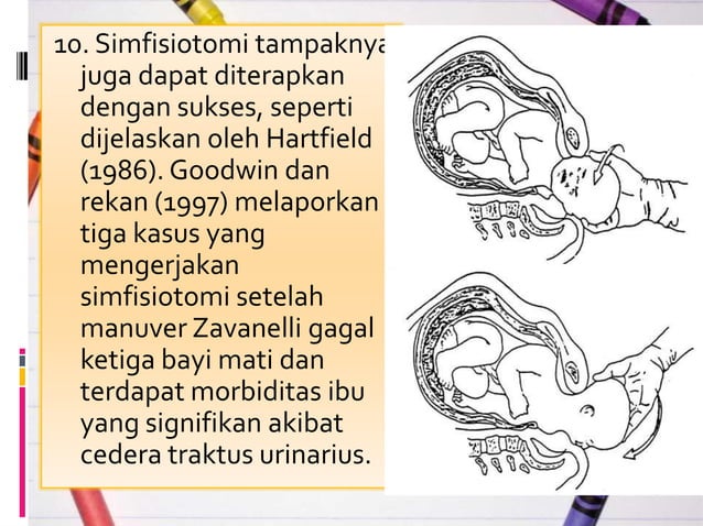 Distosia bahu | PPTX