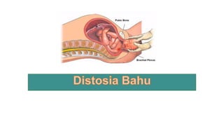 Distosia bahu.pptx