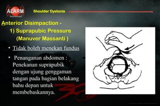 Distosia bahu (Penyulit pada Persalinan) | PPT