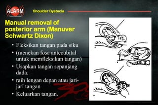 Distosia bahu (Penyulit pada Persalinan) | PPT