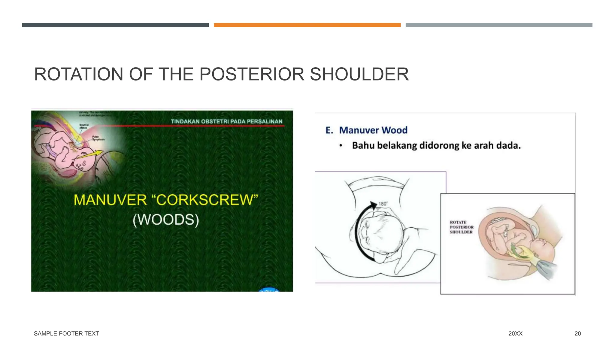 Distosia bahu dan sistem rujukan.......... | PPT