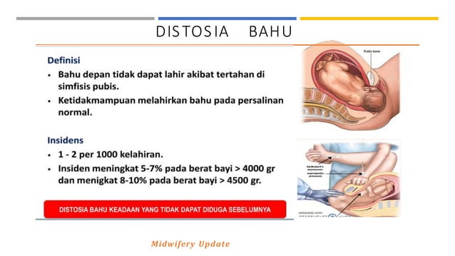 Distosia bahu dan sistem rujukan.......... | PPT