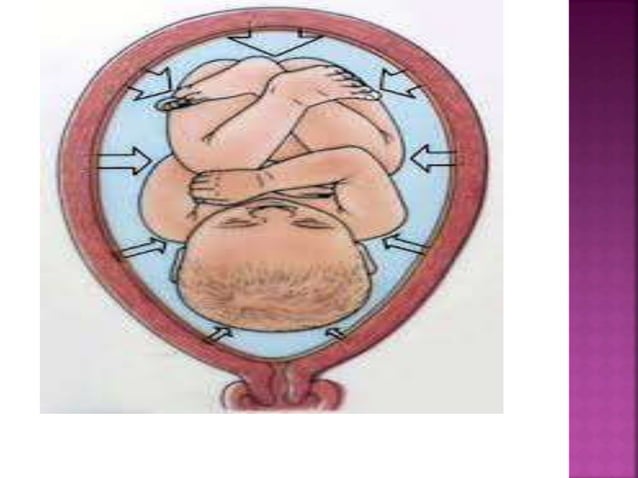 Distosia karena kelainan his | PPTX