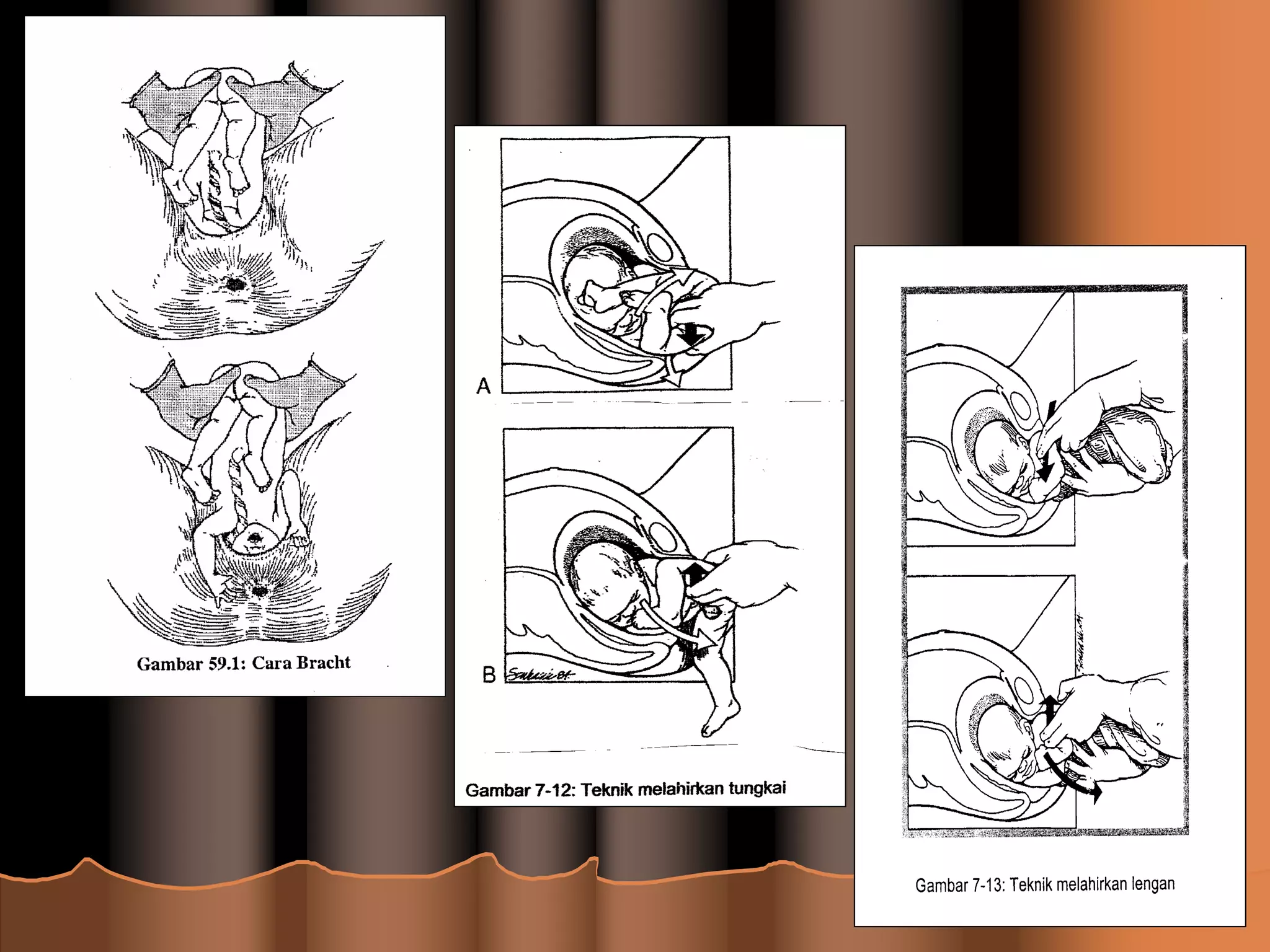 Distosia & Kelainan Letak Malposisi.ppt