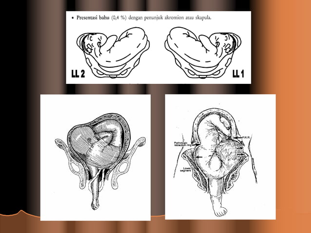 Distosia & Kelainan Letak Malposisi.ppt