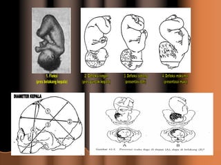 Distosia & Kelainan Letak Malposisi.ppt