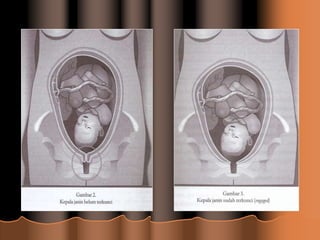 Distosia & Kelainan Letak Malposisi.ppt