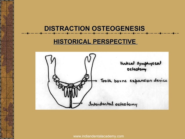 Distraction osteogenesis | PPT | Bone and Joint Conditions | Diseases ...