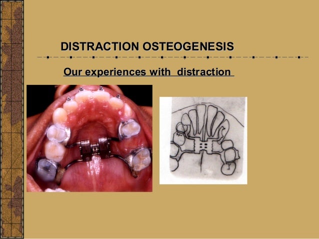 Distraction osteogenesis