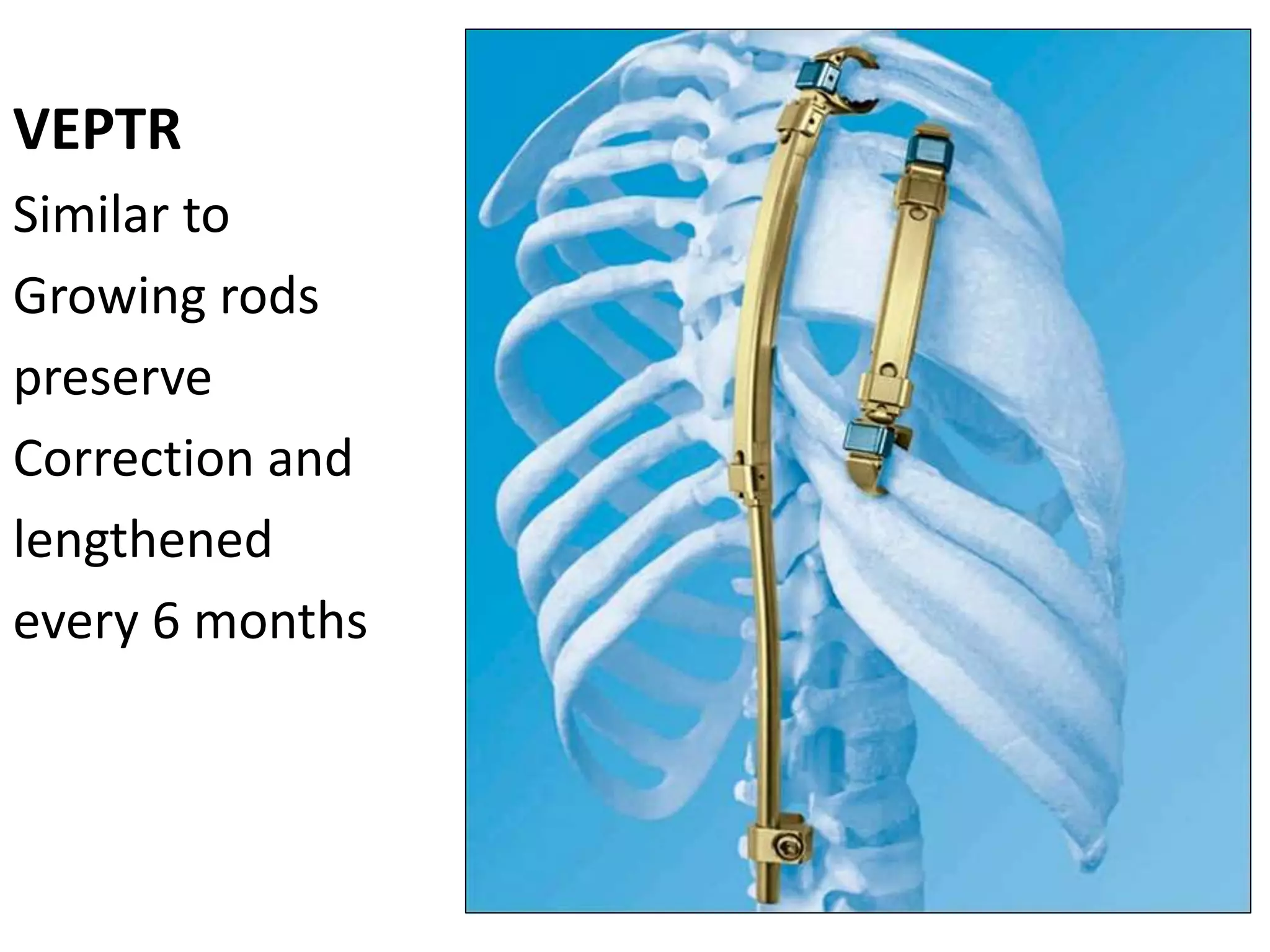 Distraction based surgery 30 | PPT