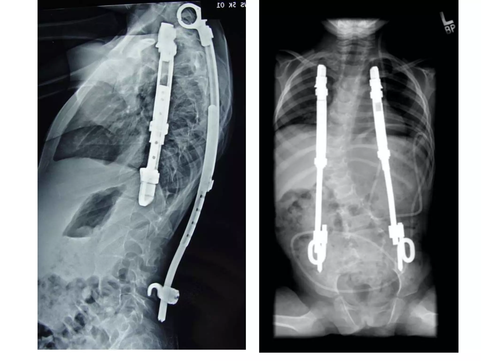 Distraction based surgery 30 | PPT