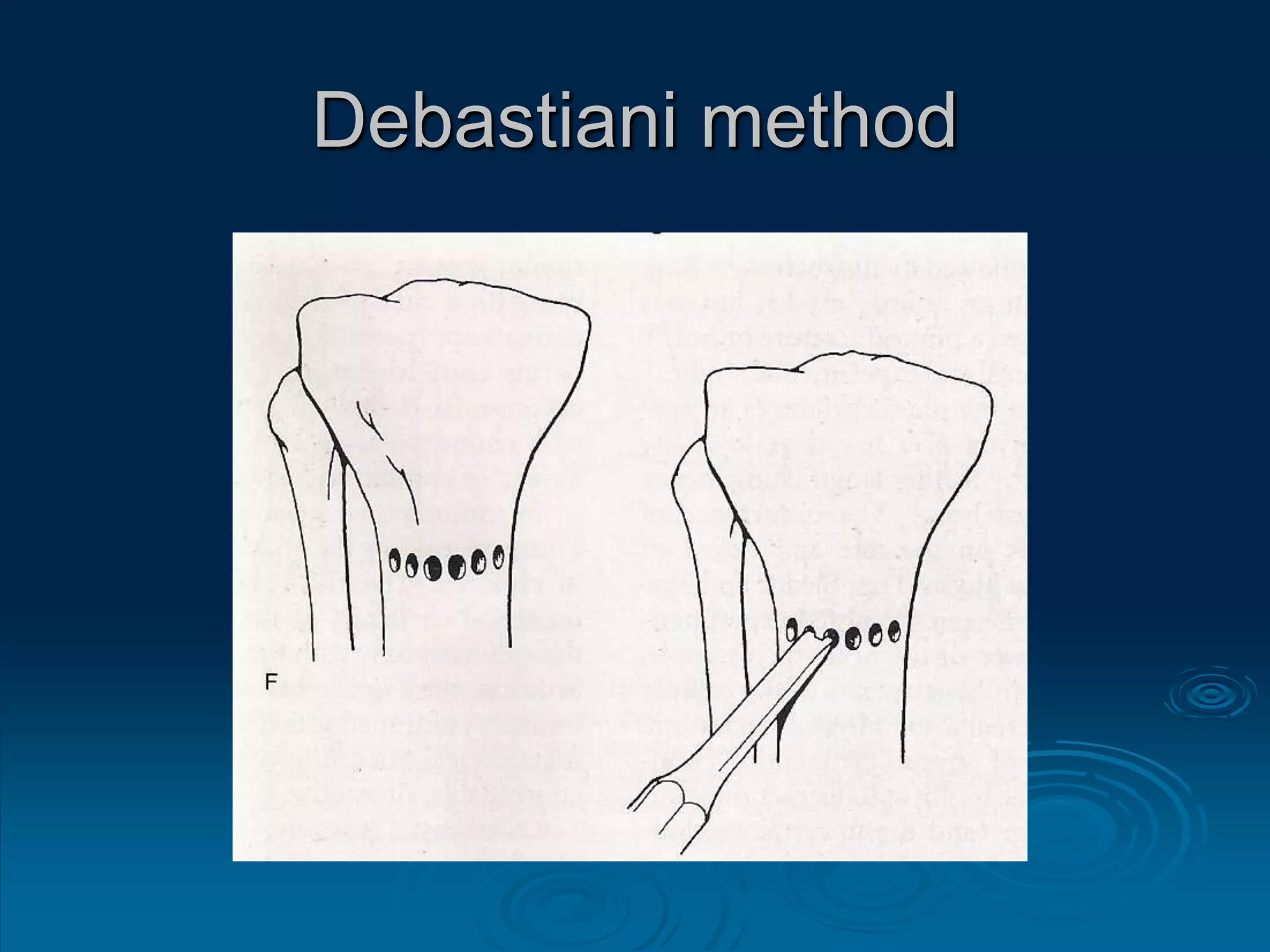 Distraction histogenesis in Ilizarov | PPT