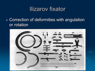 Distraction histogenesis in Ilizarov | PPT