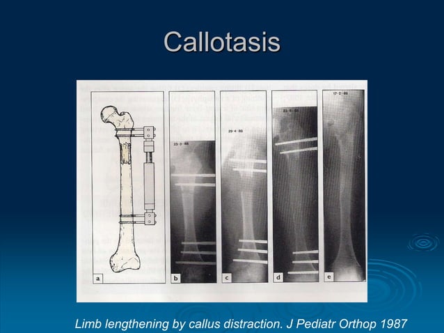 Distraction histogenesis in Ilizarov | PPT