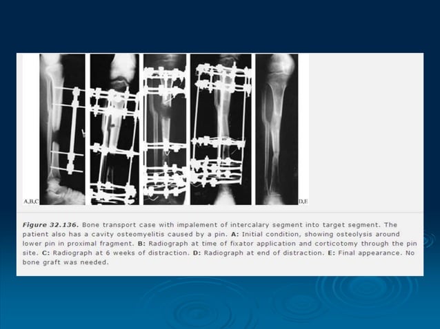 Distraction histogenesis in Ilizarov | PPT