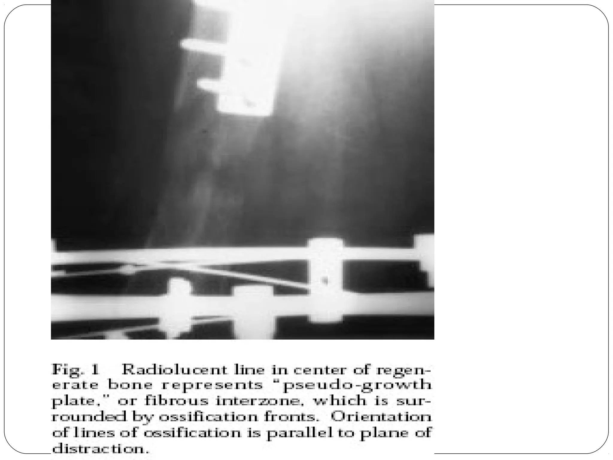 Distraction osteogenesis | PPT