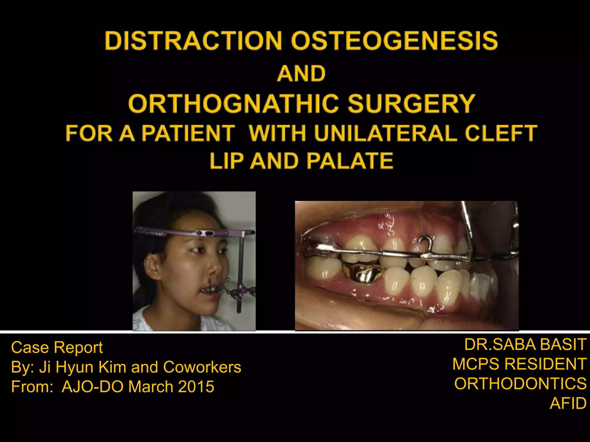 Distraction osteogenesis in CLP | PPTX