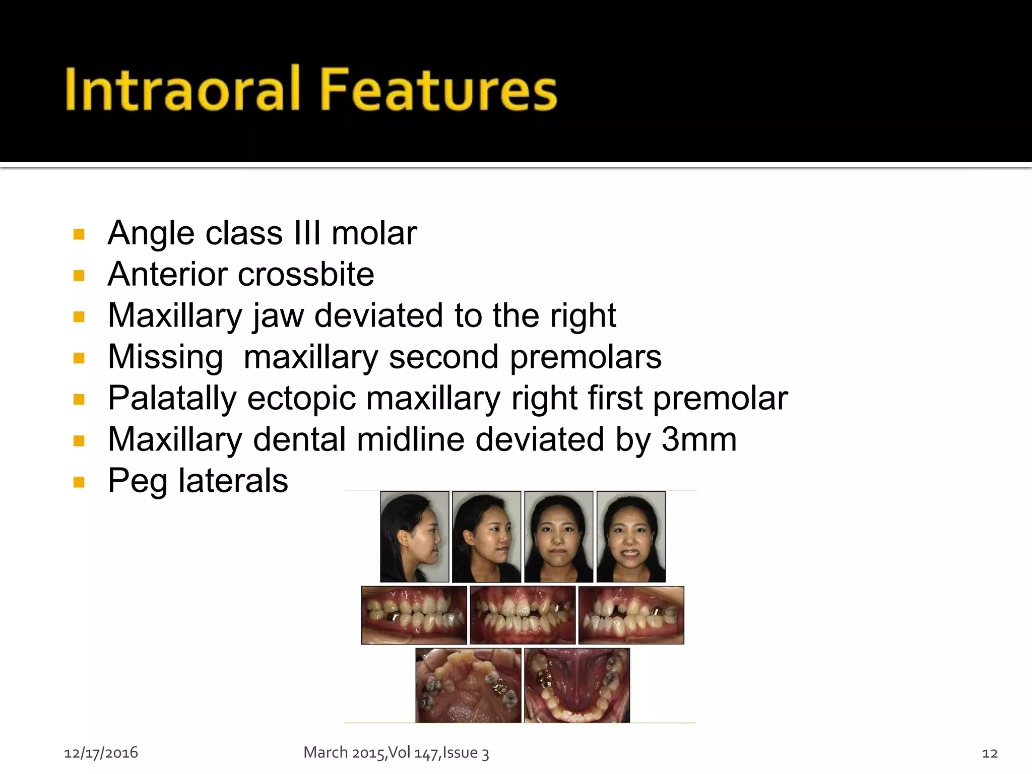 Distraction osteogenesis in CLP | PPTX