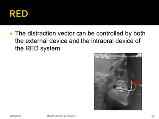 Distraction osteogenesis in CLP | PPTX