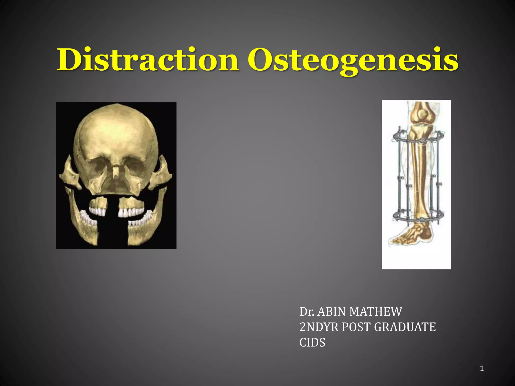 Distraction osteogenesis | PPTX