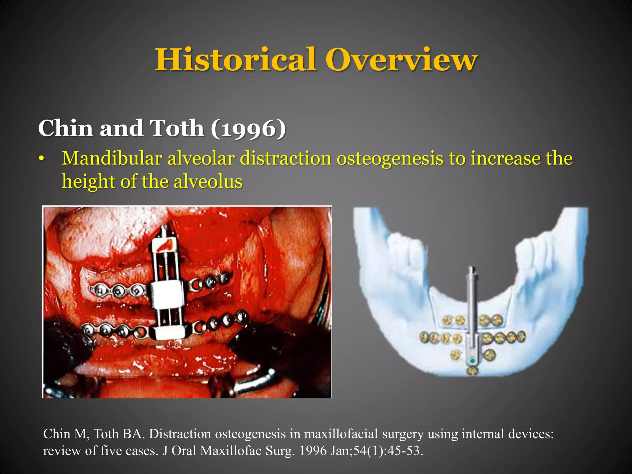 Distraction osteogenesis | PPTX