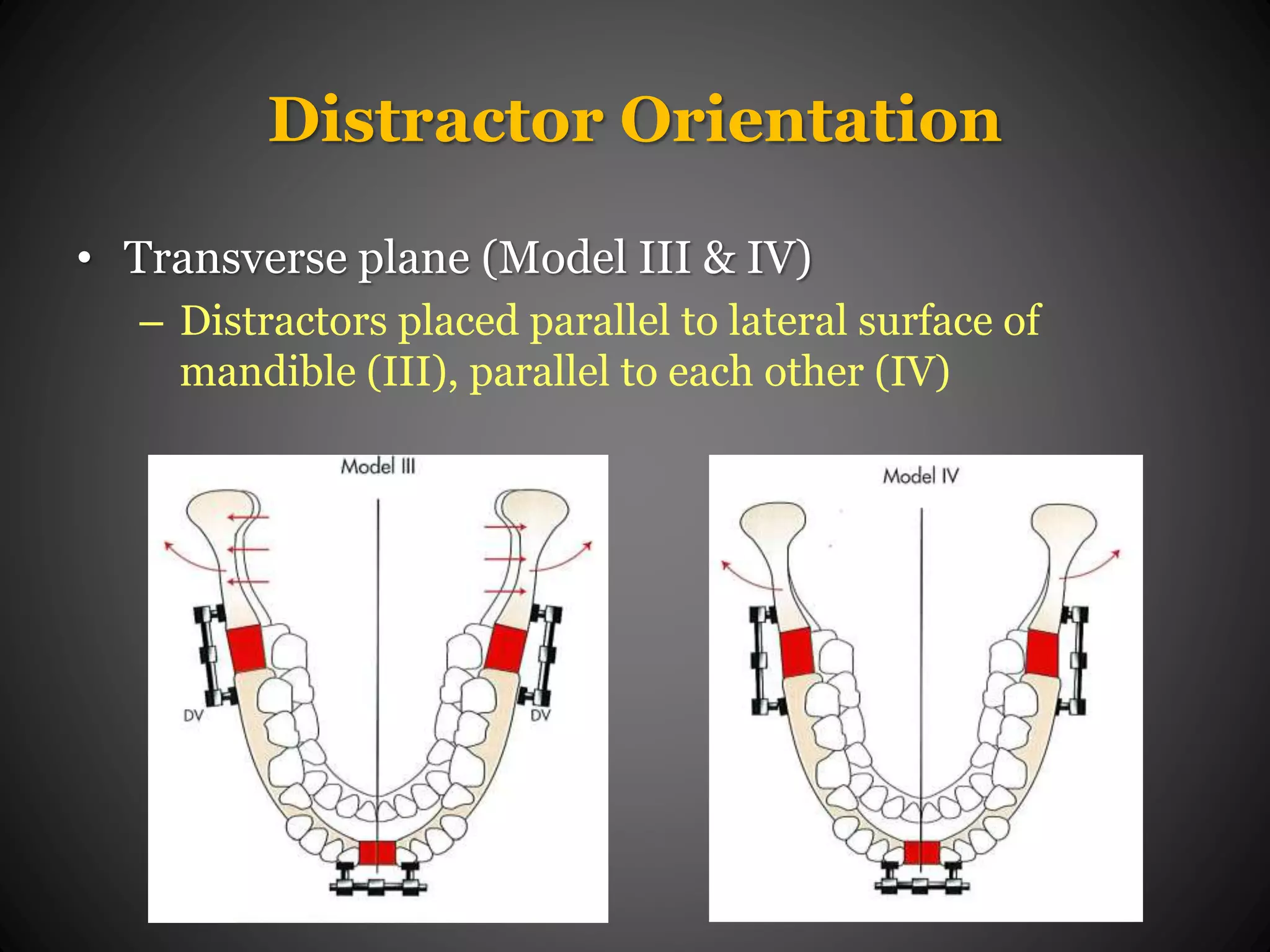 Distraction osteogenesis | PPTX