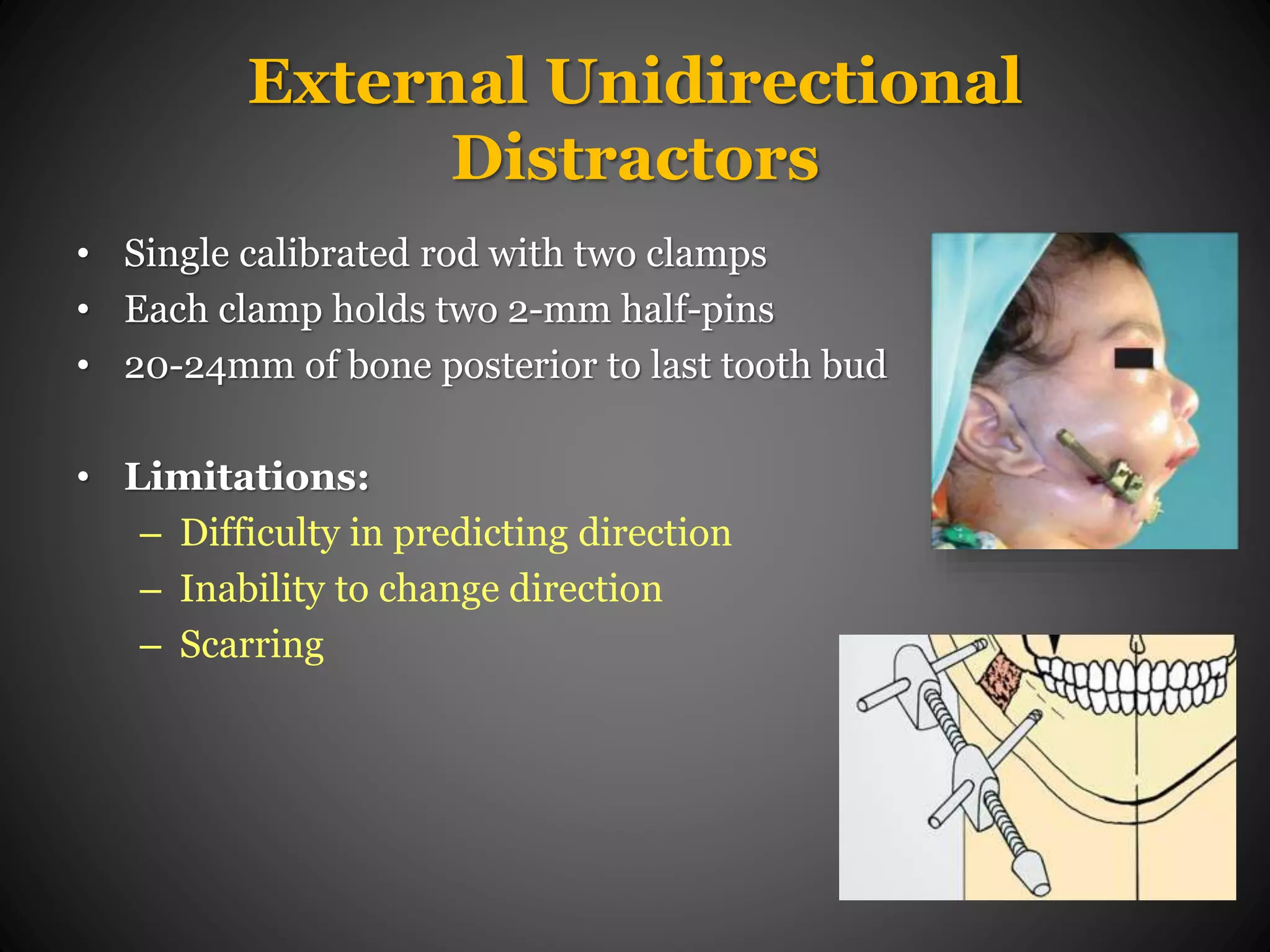 Distraction osteogenesis | PPTX