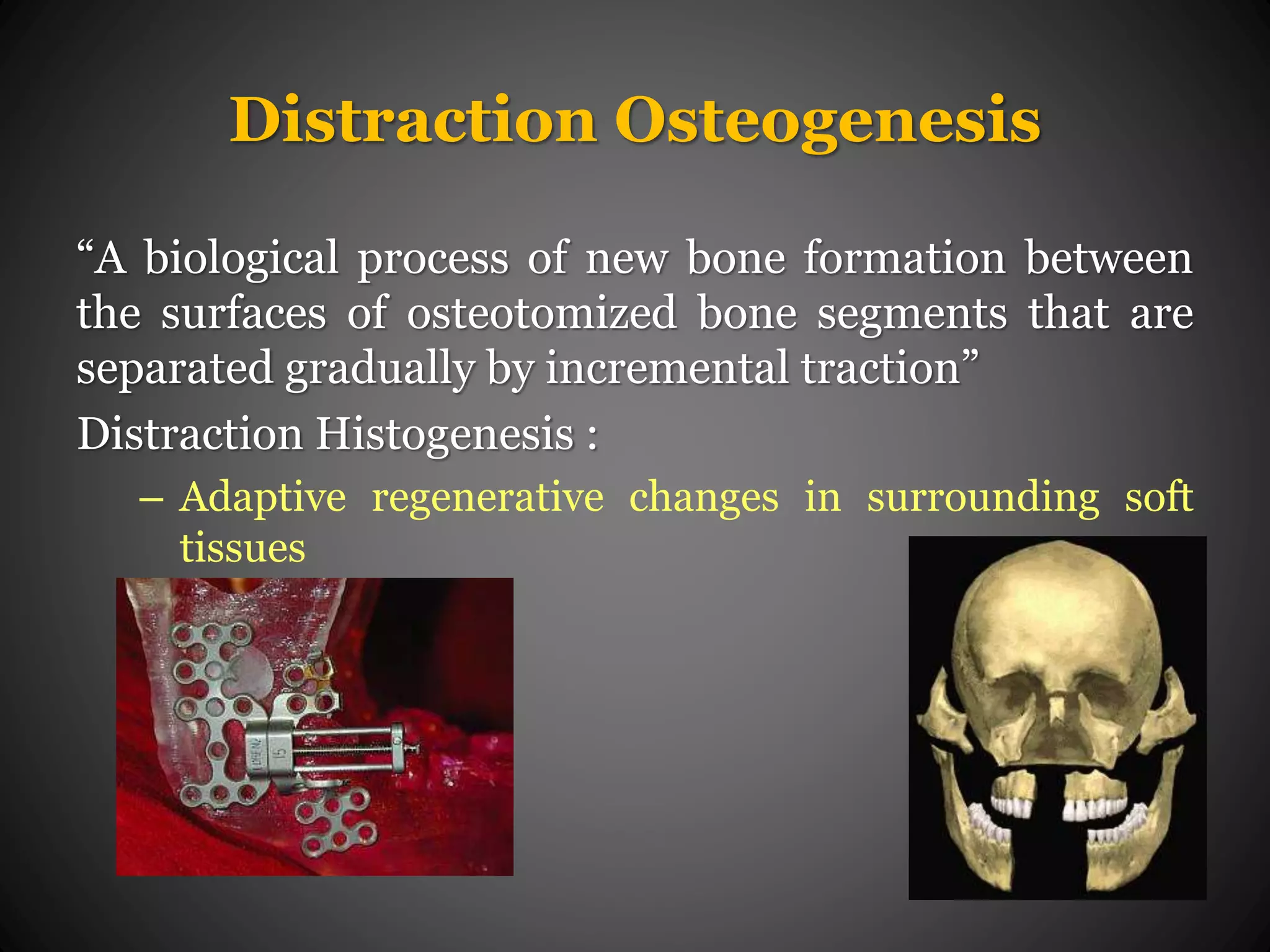 Distraction osteogenesis | PPTX