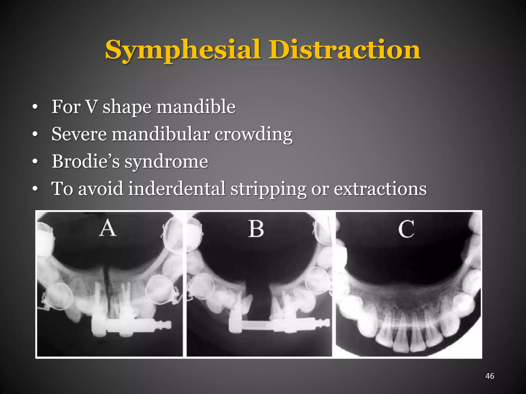 Distraction osteogenesis | PPTX