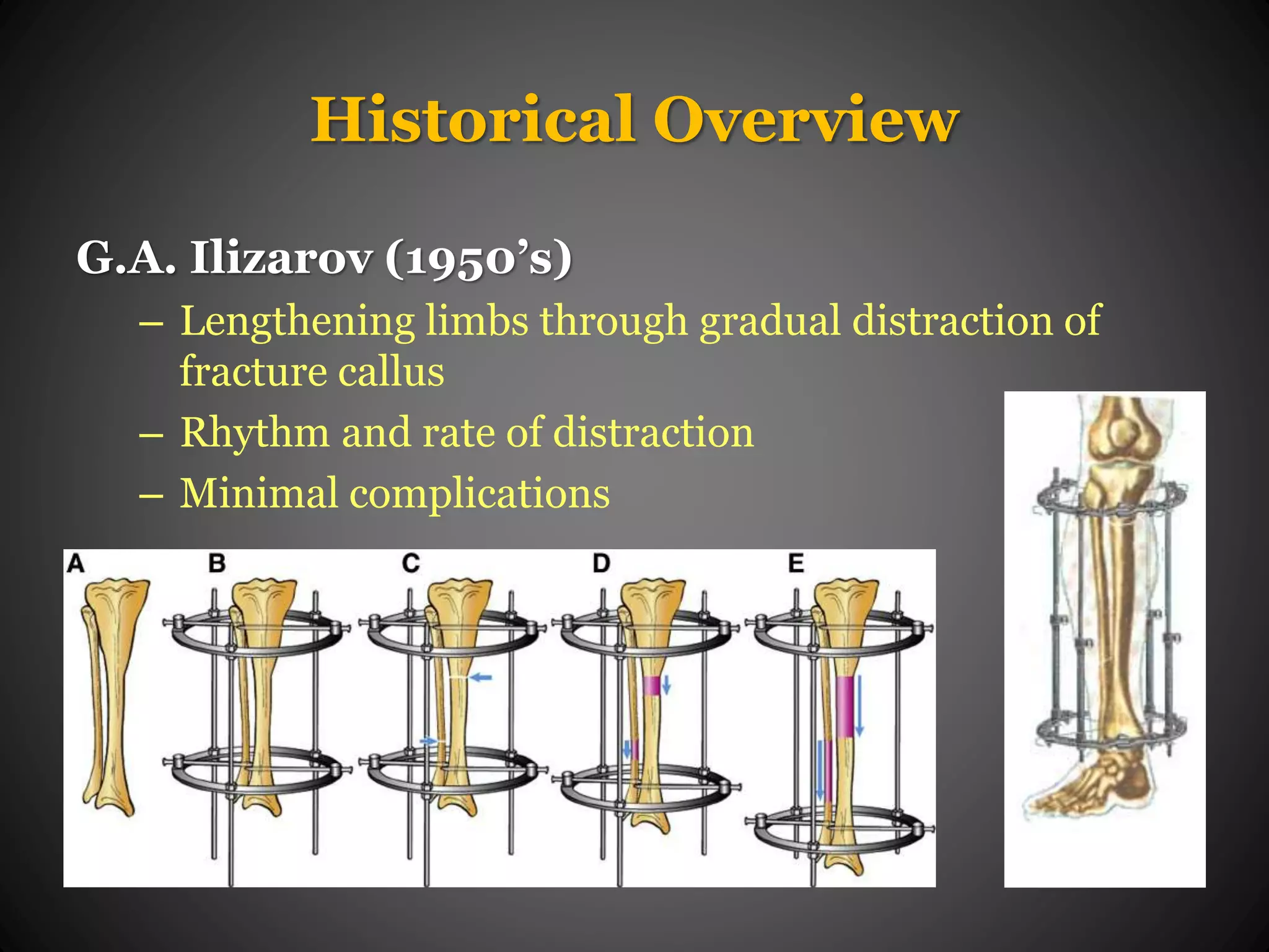 Distraction osteogenesis | PPTX