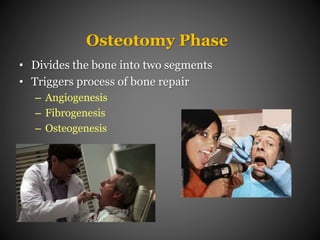 Distraction osteogenesis | PPTX